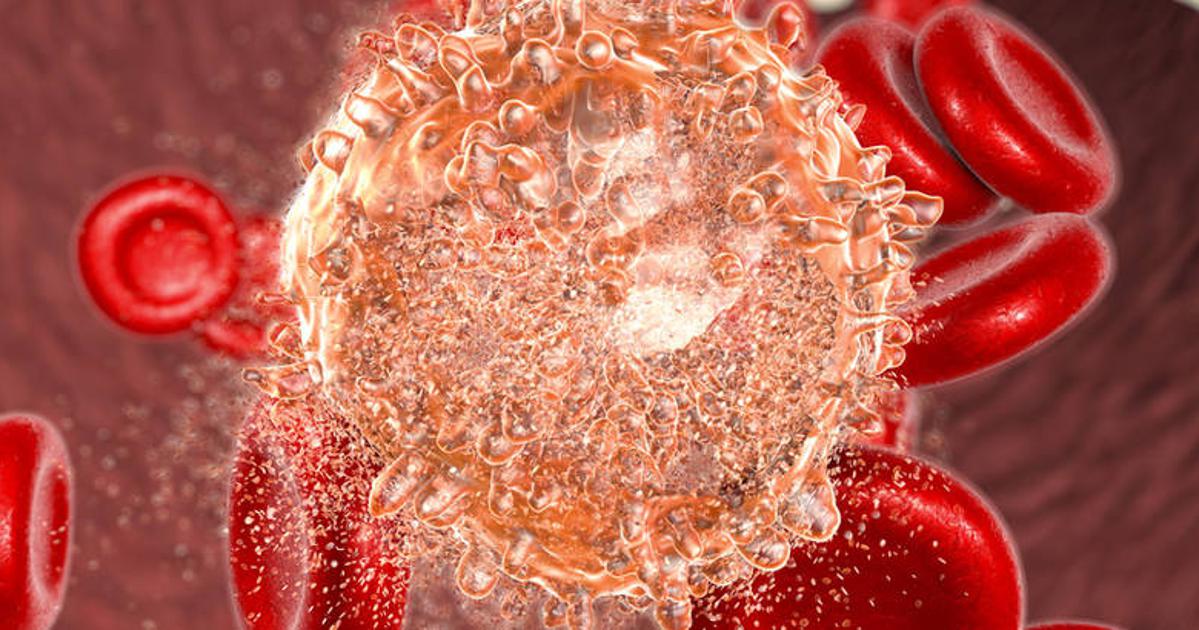 Simptomi leukemije i kako se dolazi do dijagnoze - www.vecernji.ba